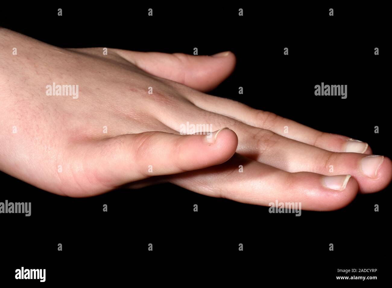 Dislocated finger from a netball injury in an 11-year-old girl. No bone ...