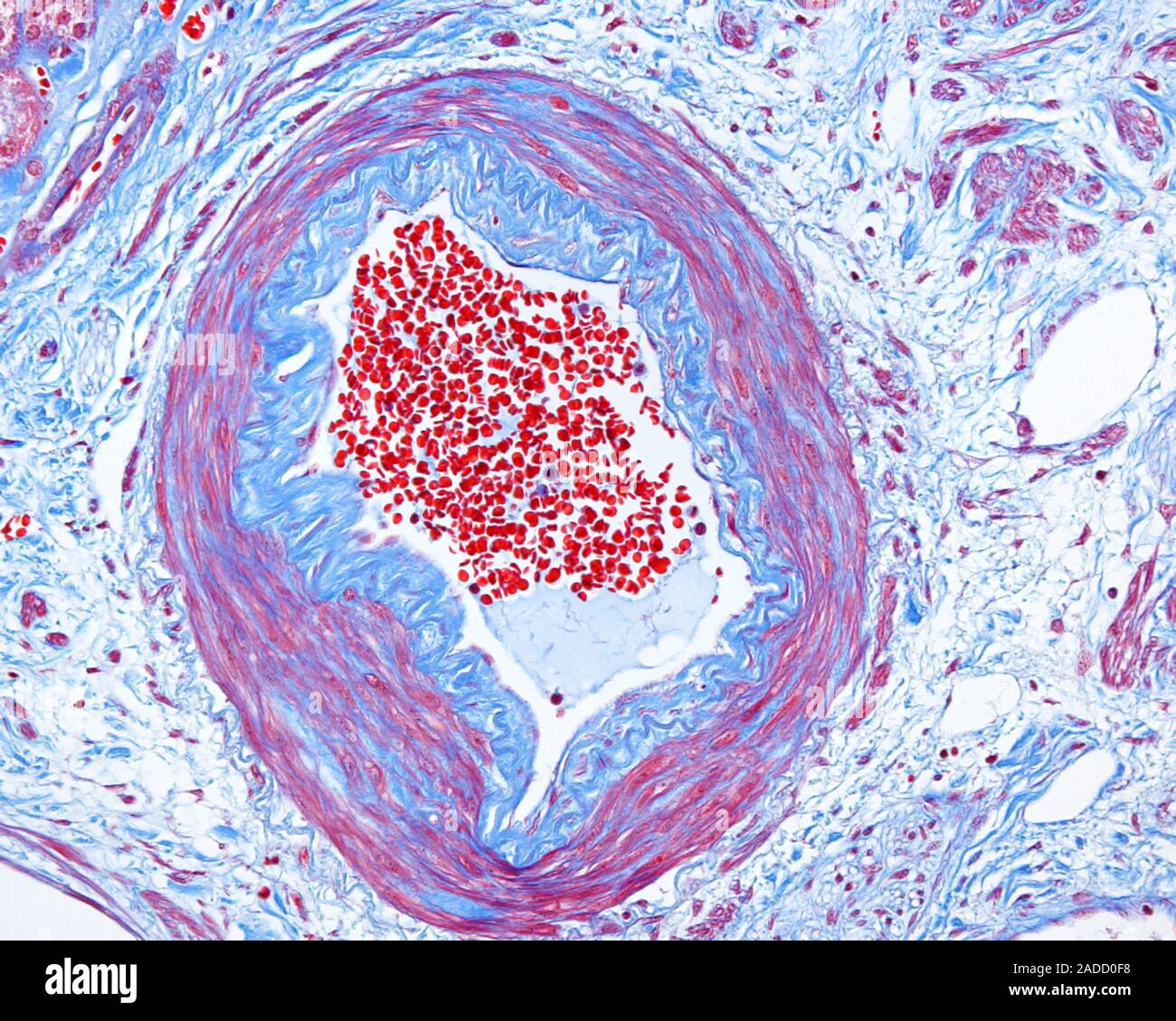 Muscular artery showing a thickening of the intima (innermost) layer ...