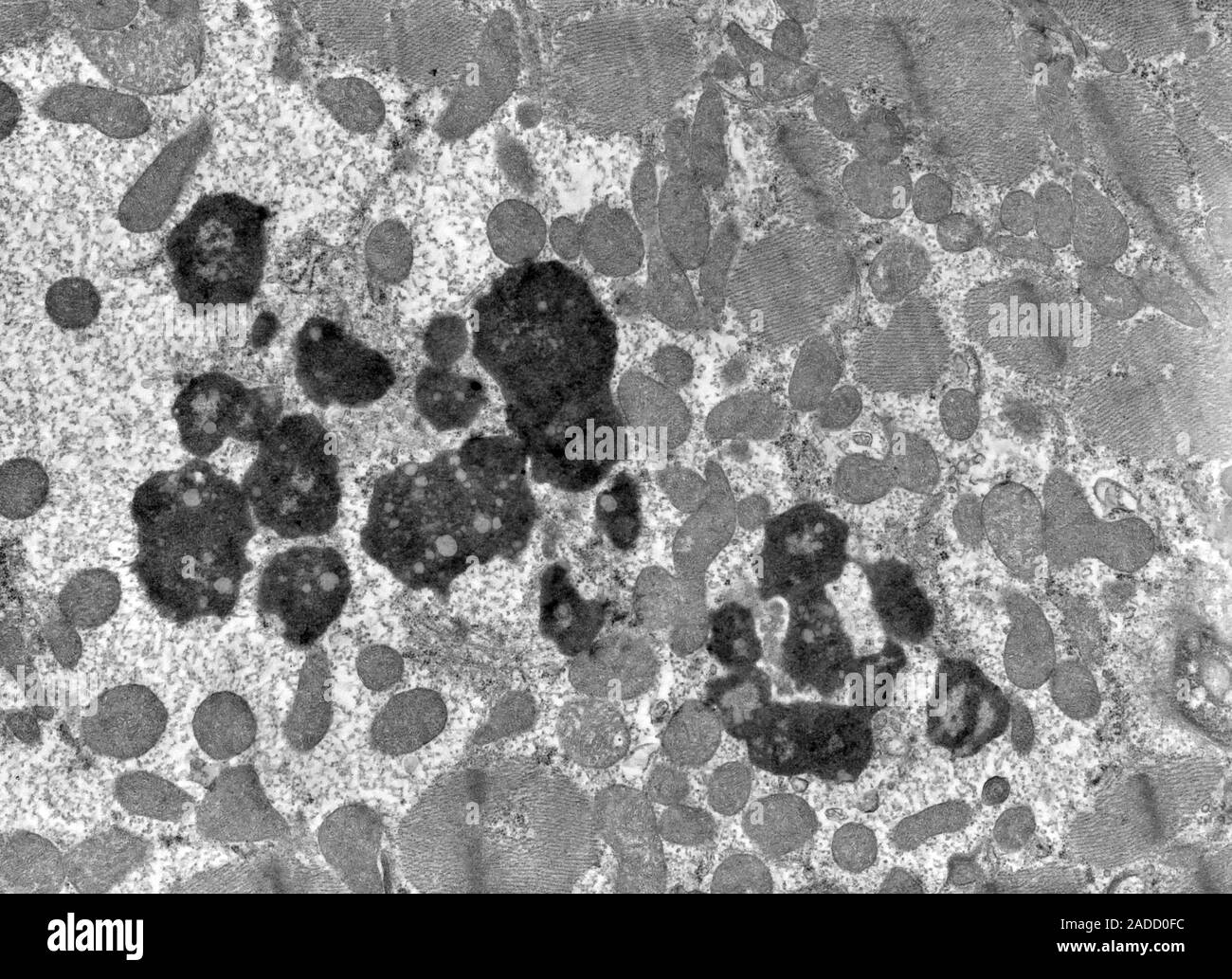 Transmission electron micrograph (TEM) showing large lipofuscin pigment ...
