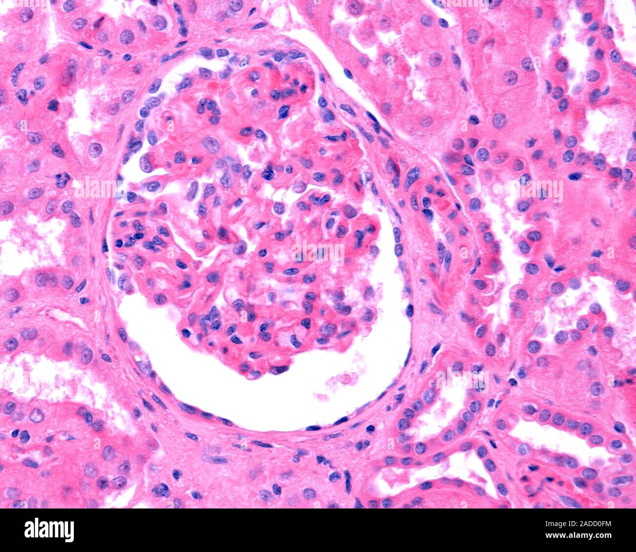 Membranous glomerulonephritis, light micrograph. Kidney glomerulus ...