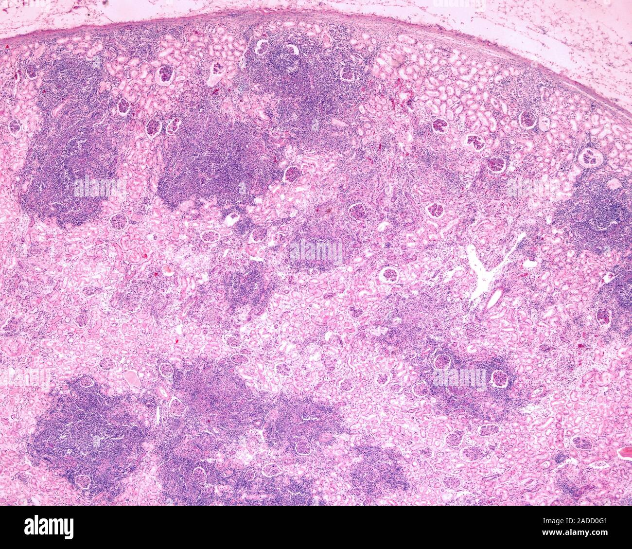 Low magnification light micrograph showing a kidney affected by a ...