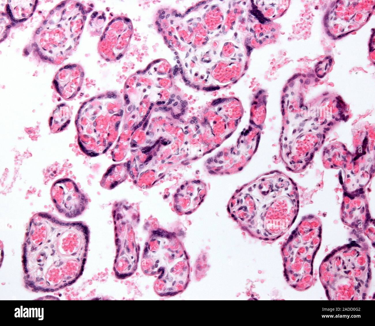 Light micrograph of a hypermature, or aging, placenta. The small ...