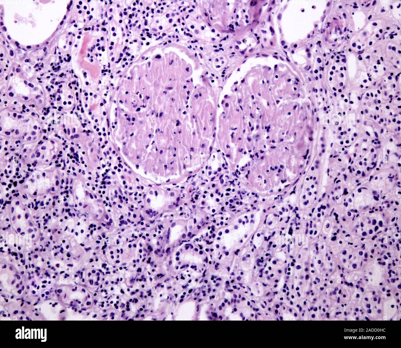 Light micrograph of total hyalinization of renal glomeruli in a case of ...