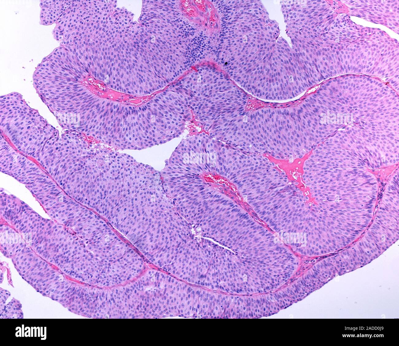 Light micrograph of a urinary bladder papilloma formed by papillae with ...