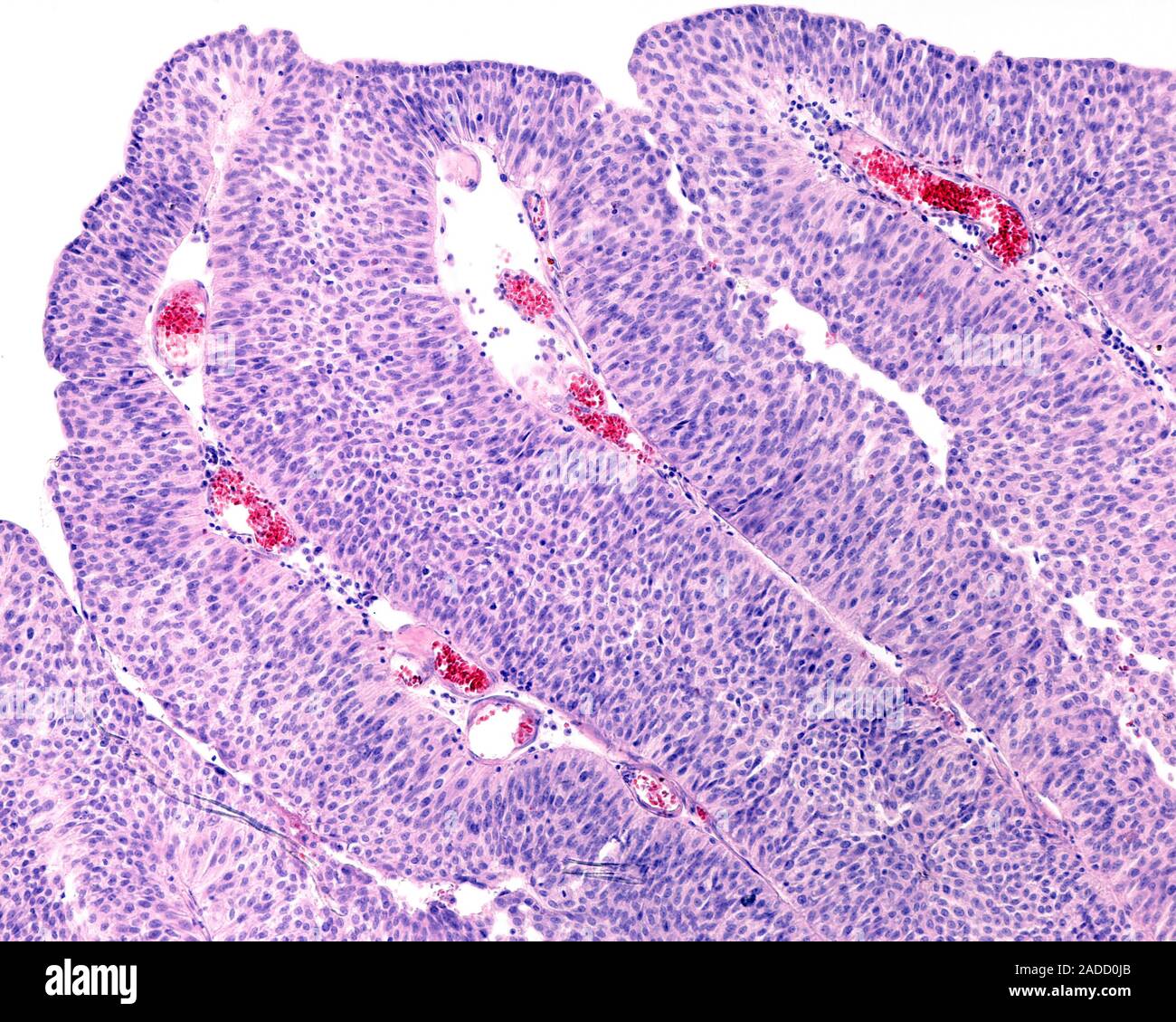 Light micrograph of a urinary bladder papilloma formed by papillae with ...