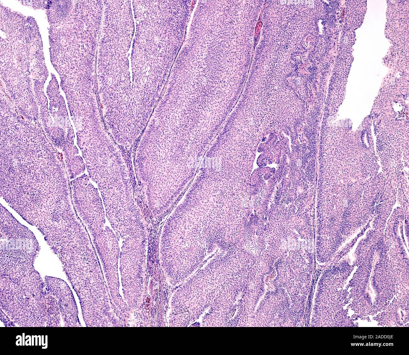 Light micrograph of a urinary bladder papilloma formed by papillae with ...