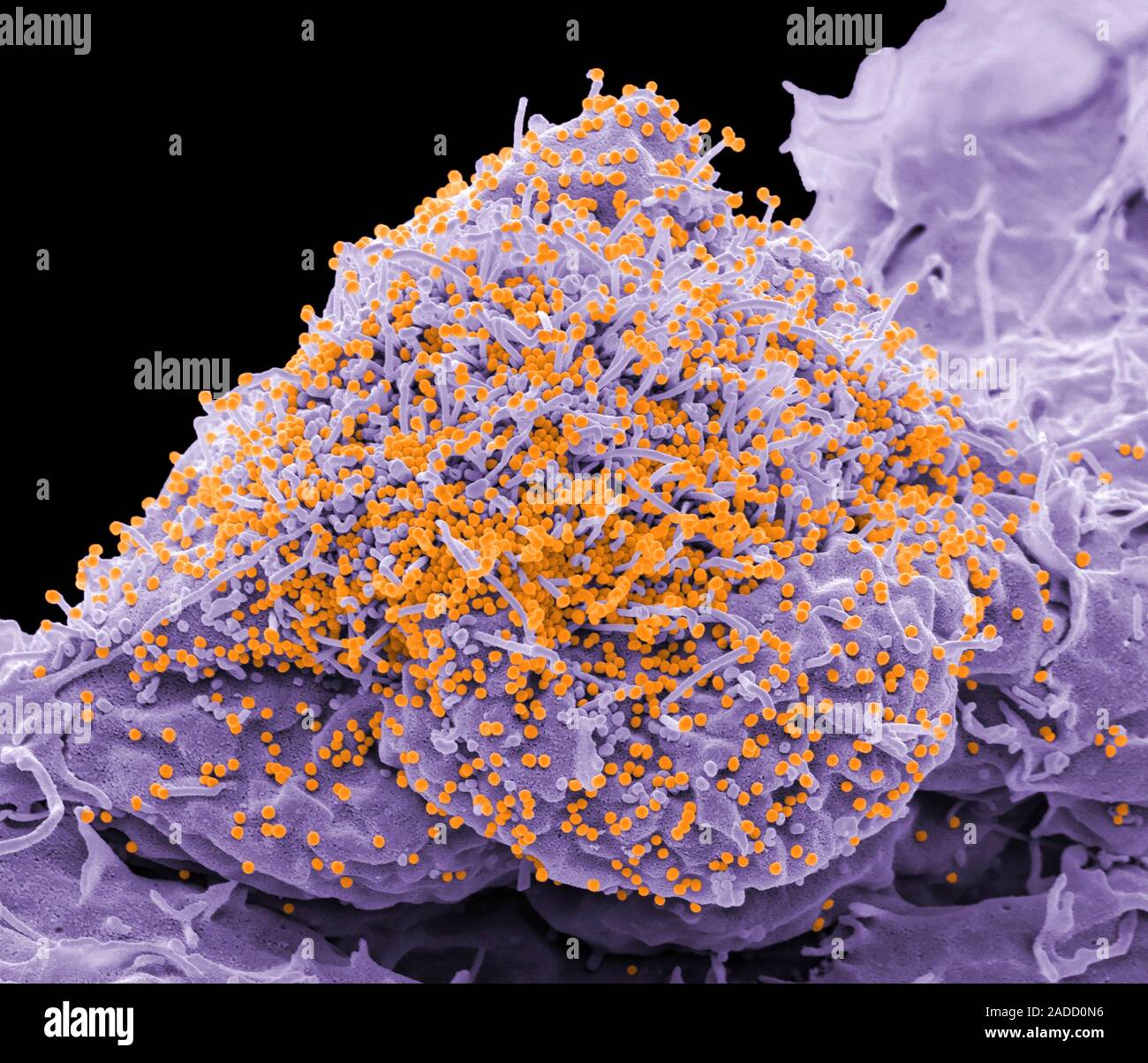 HIV infected 293T cell. Coloured scanning electron micrograph (SEM) of ...