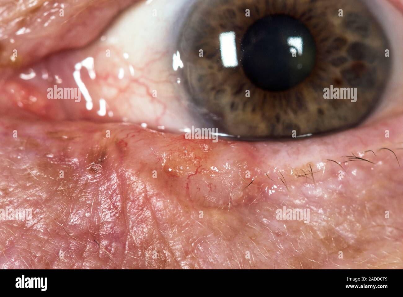 Basal cell carcinoma on the left lower eyelid of a 76-year-old woman ...
