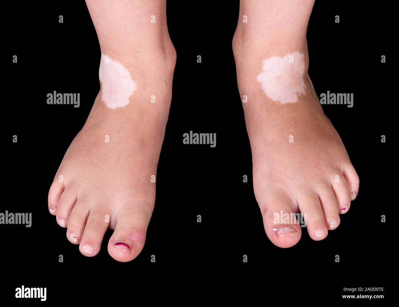 Vitiligo skin condition. Non-pigmented skin on the ankles of a 7-year ...