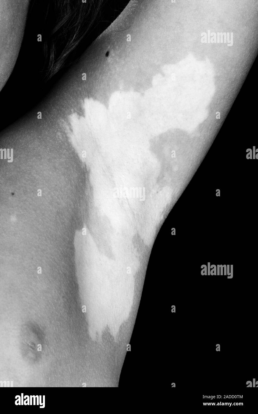 Vitiligo skin condition. Non-pigmented skin on the armpit of a 7-year ...