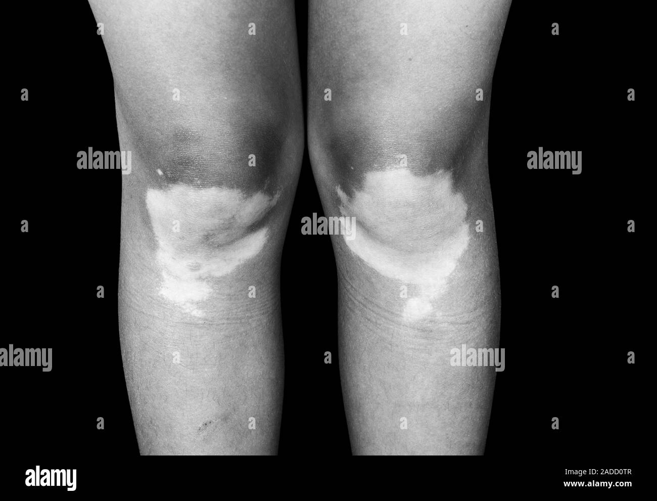 Vitiligo skin condition. Non-pigmented skin on the knees of a 7-year ...