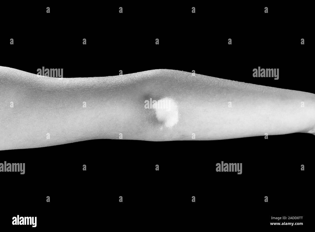 Vitiligo skin condition. Non-pigmented skin on the elbow of a 7-year ...