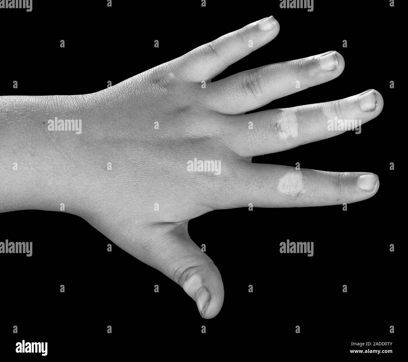 Vitiligo skin condition. Non-pigmented skin on the fingers of a 7-year ...
