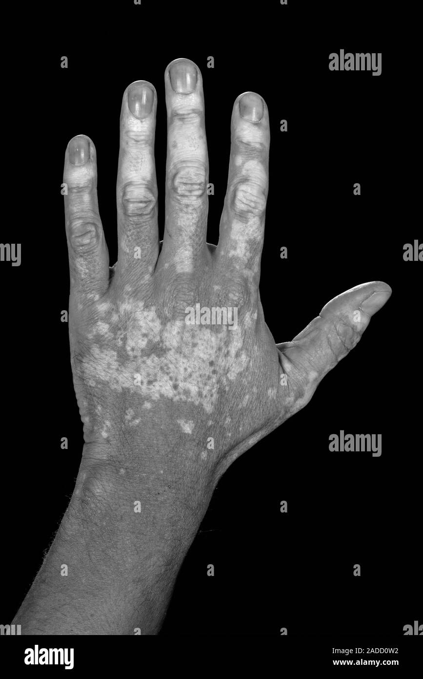 Vitiligo skin condition. Non-pigmented skin on the hand of a 47-year ...