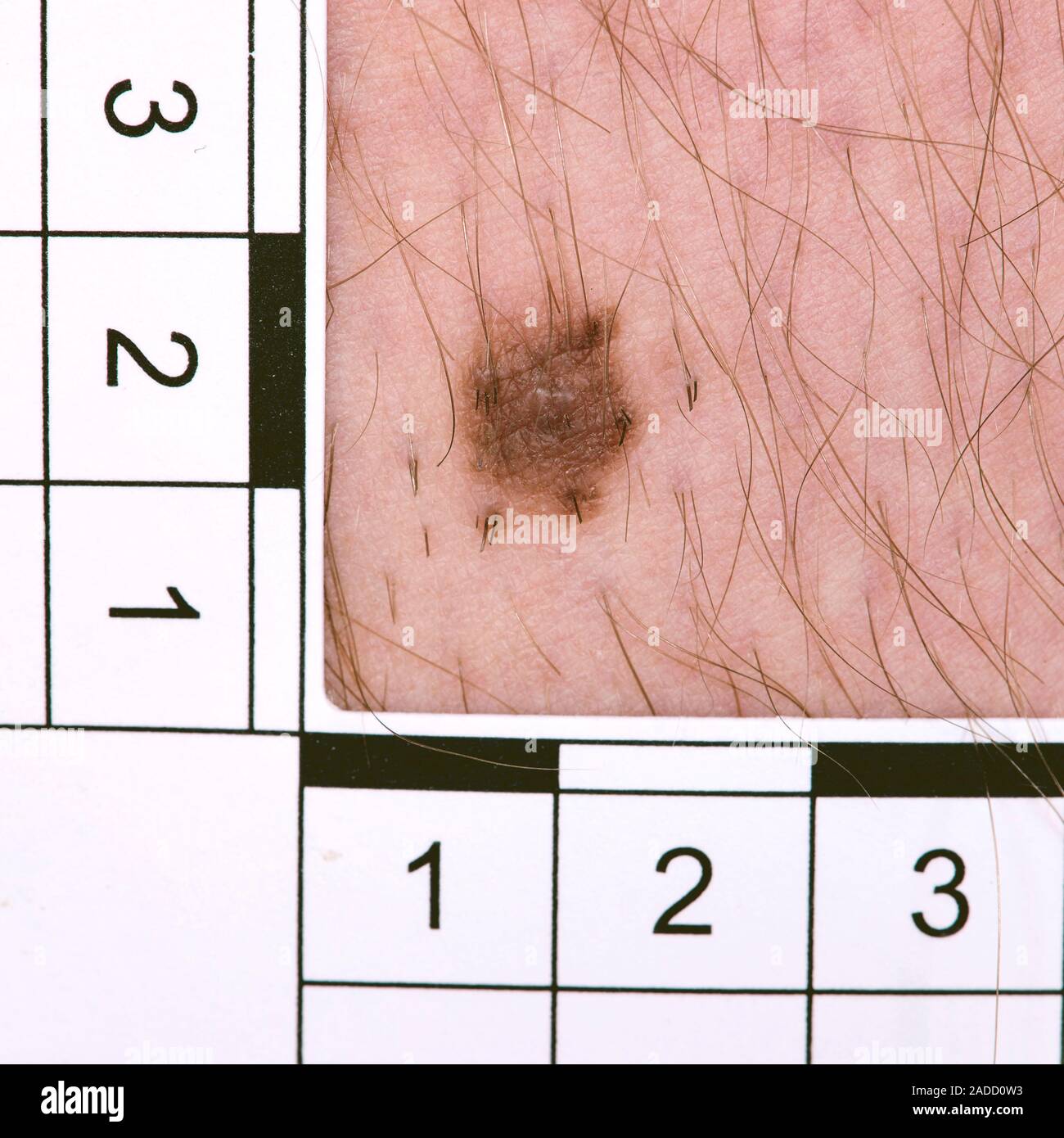 Mole diagnosis. Close-up of a mole on the leg of an 18-year-old man ...