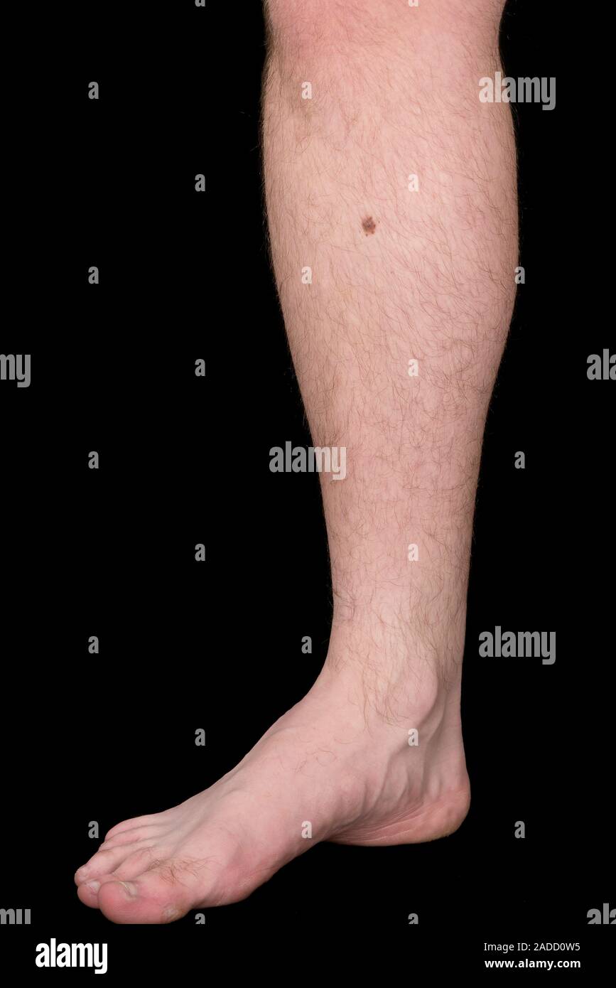 Mole on right leg of an 18-year-old man. Also known as a pigmented ...