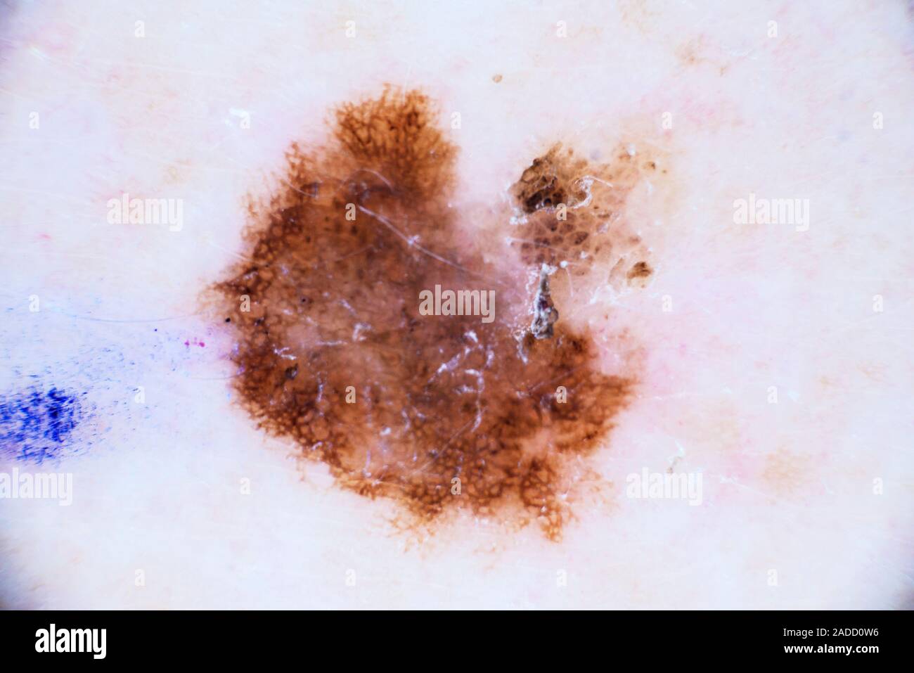 Mole diagnosis. Dermascope image of a mole on the left upper back of a ...