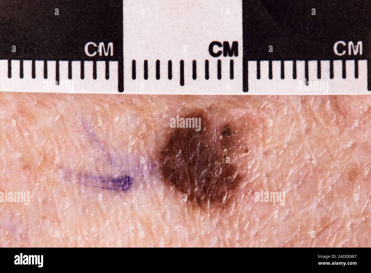 Mole diagnosis. Close-up of a mole on the left upper back of a female ...