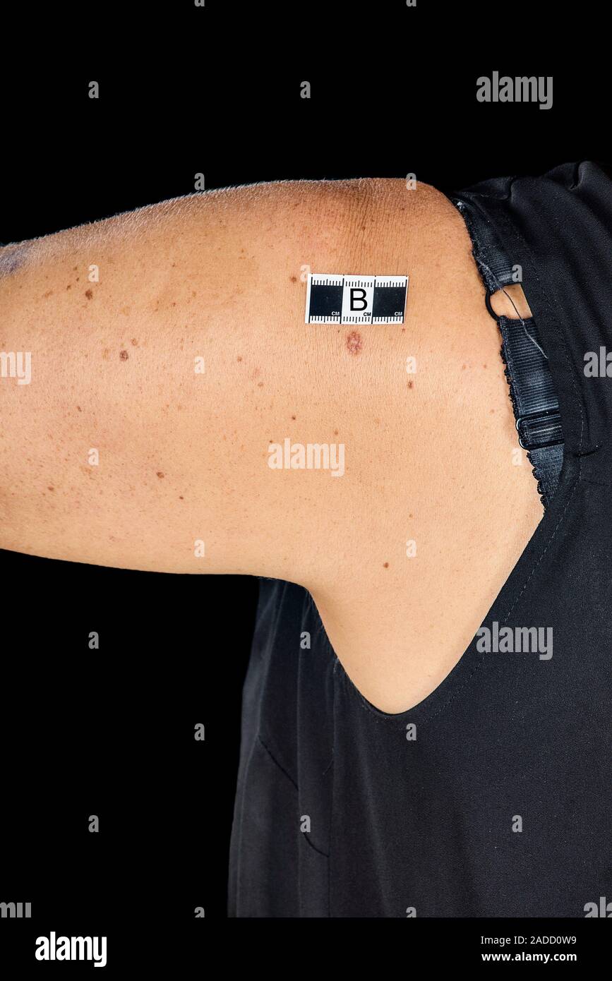 Dermatofibroma diagnosis. Examination of a dermatofibroma on the left ...
