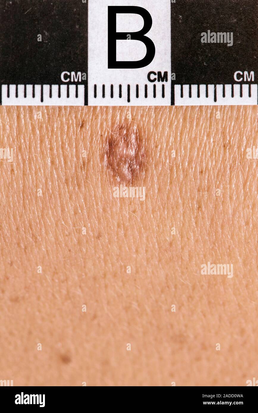 Dermatofibroma diagnosis. Close-up of a dermatofibroma on the left ...