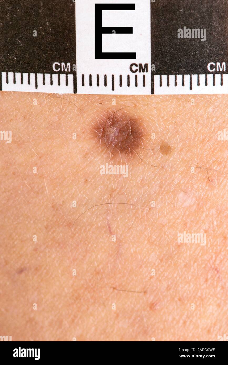 Dermatofibroma diagnosis. Close-up of a dermatofibroma on the back of ...