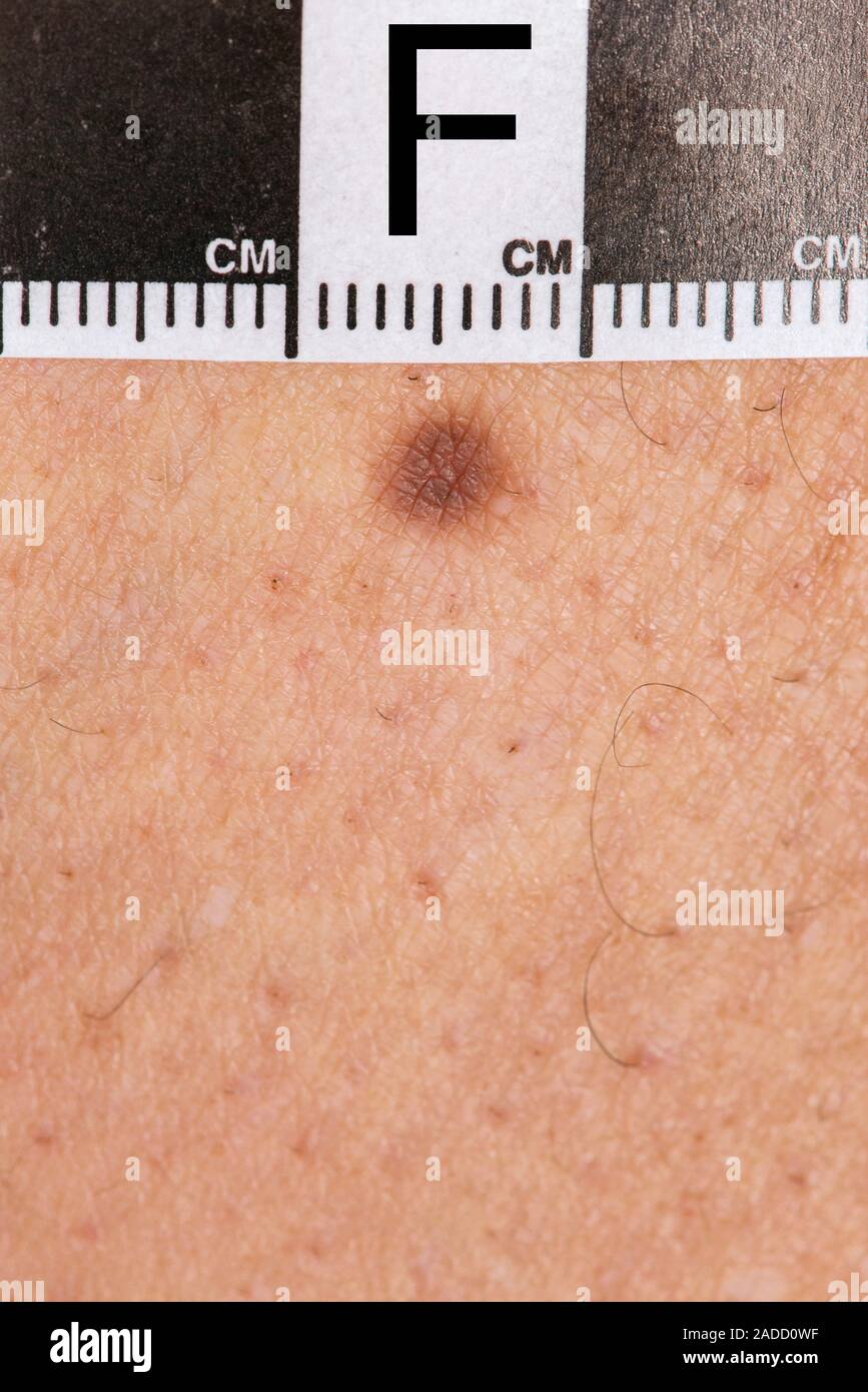 Dermatofibroma diagnosis. Close-up of a dermatofibroma on the back of ...