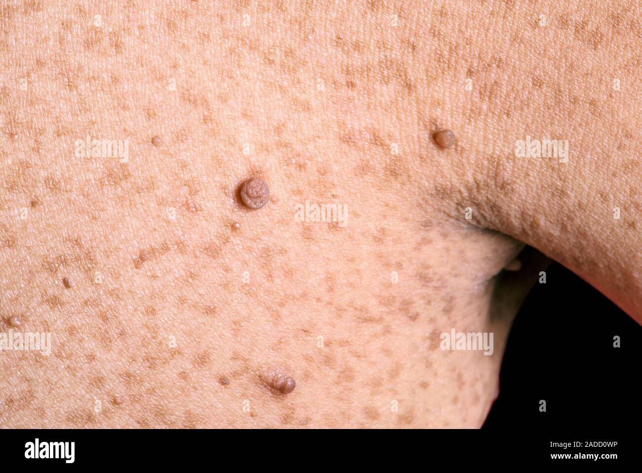 Neurofibromatosis. Neurofibroma growths on the skin near an armpit of a ...