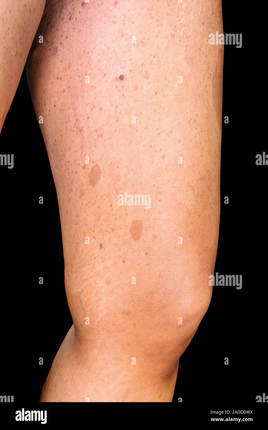 Neurofibromatosis. Neurofibroma growths on the leg of a 44-year-old ...