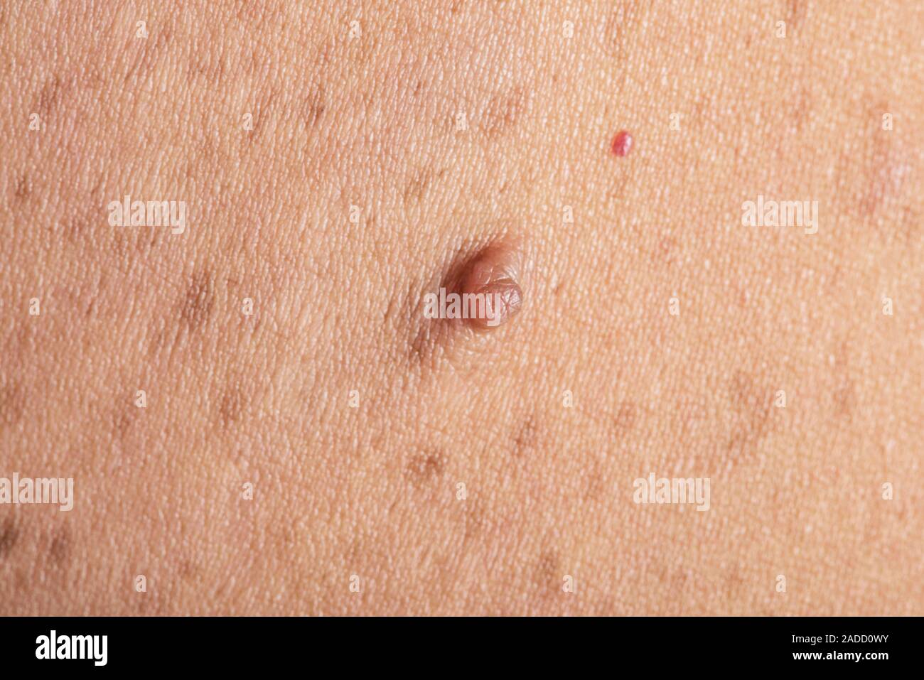 Neurofibromatosis. Neurofibroma growth on the skin of a 44-year-old ...