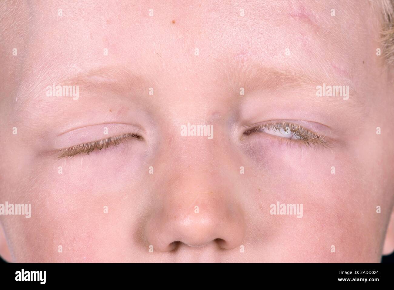 Drooping eyelid (ptosis) in a 6-year-old boy. Ptosis is normally due to ...