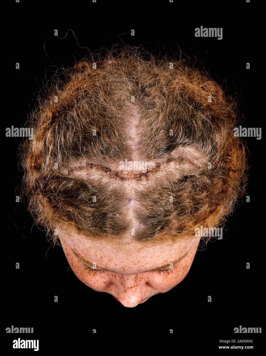 Post-operative cranioplasty scar. This operation (to repair a skull ...
