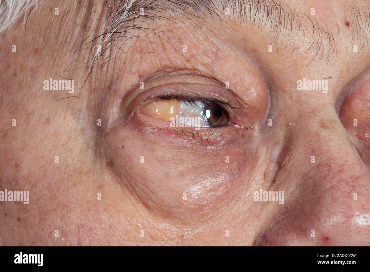 Orbital fat prolapse. Right eye of a 72-year-old man with ...