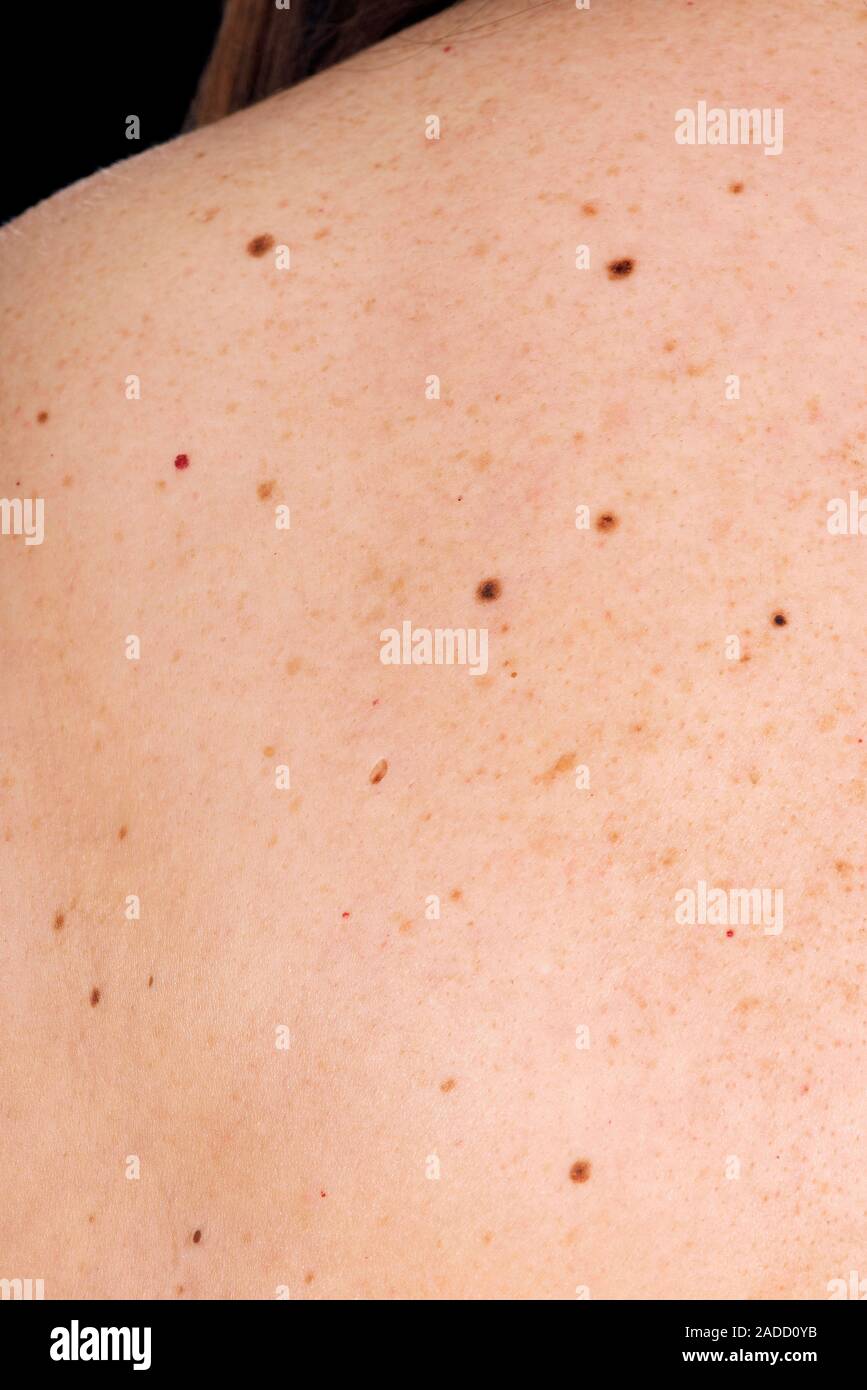 Atypical moles on the back of a 59-year-old woman. Moles are caused by ...