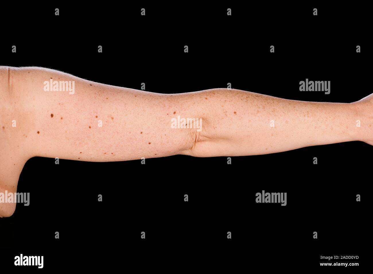 Atypical moles on the arm of a 59-year-old woman. Moles are caused by ...