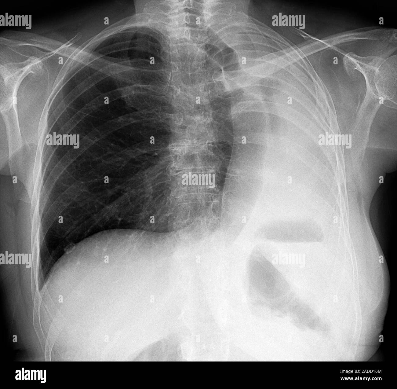Left pneumonectomy, X-ray. Pneumonectomy is the removal of a lung Stock ...