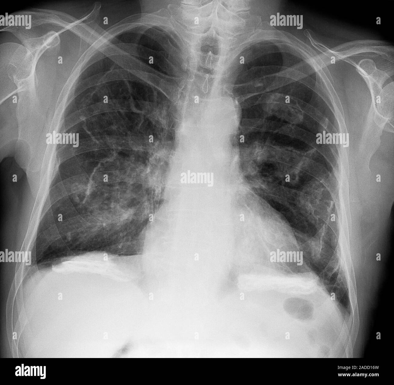 Pleural thickening due to asbestos. X-ray of the chest of a 64-year-old ...