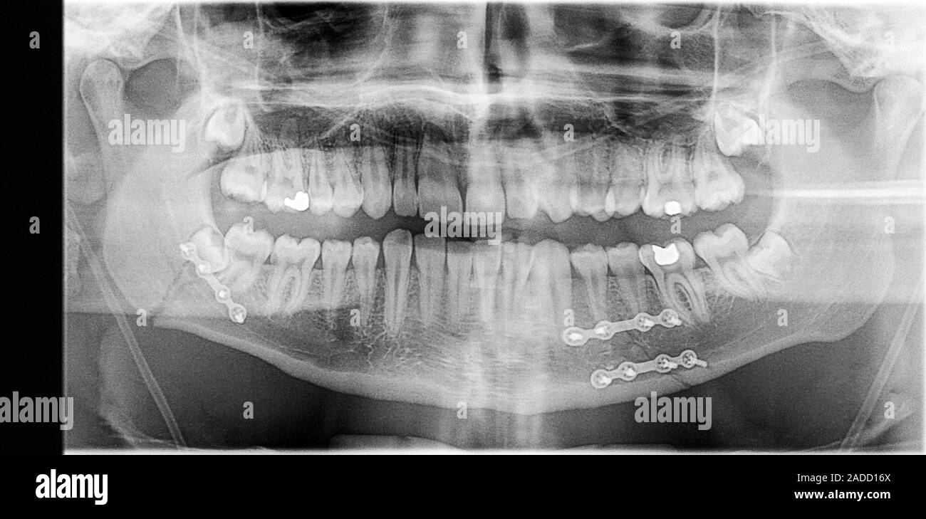 Orthopantomogram, X-ray. This is a panoramic X-ray of the full set of ...