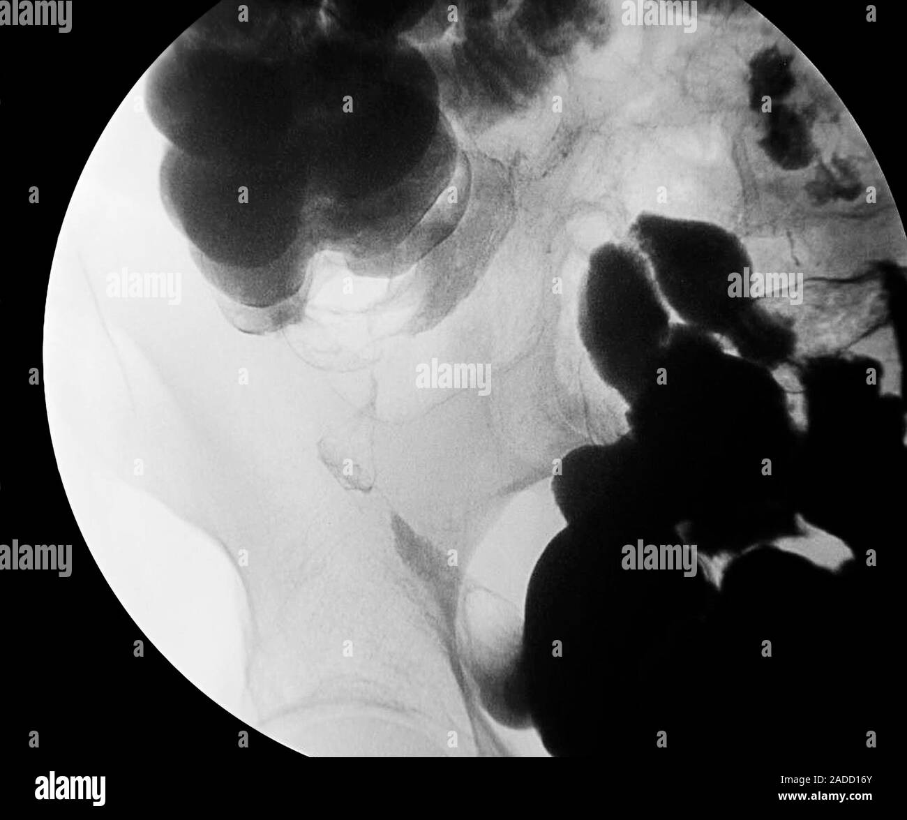 Crohn's disease. Barium meal X-ray of the terminal region of the ileum ...