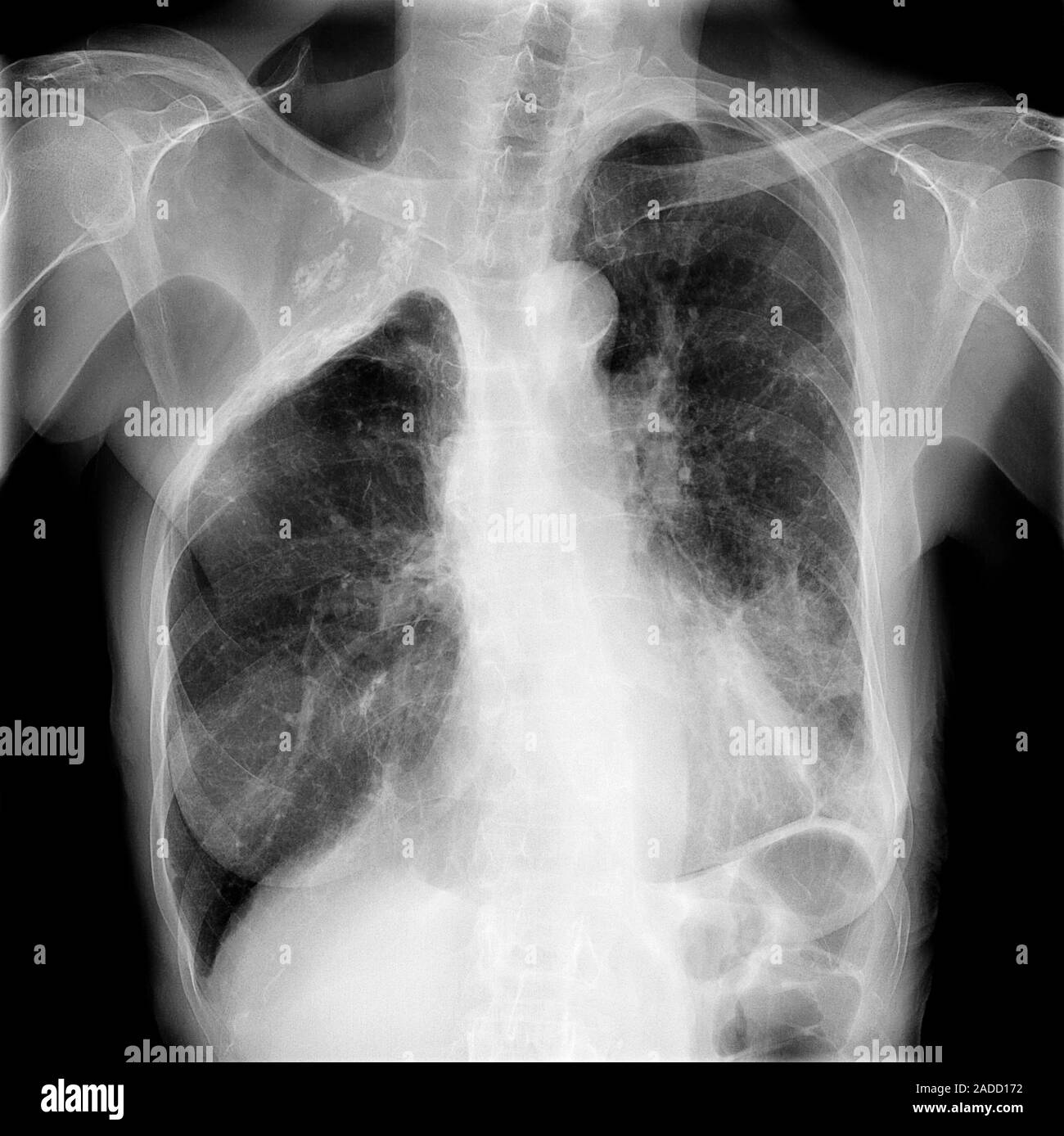 Lung cancer and thoracoplasty. X-ray of the lungs of a patient with ...