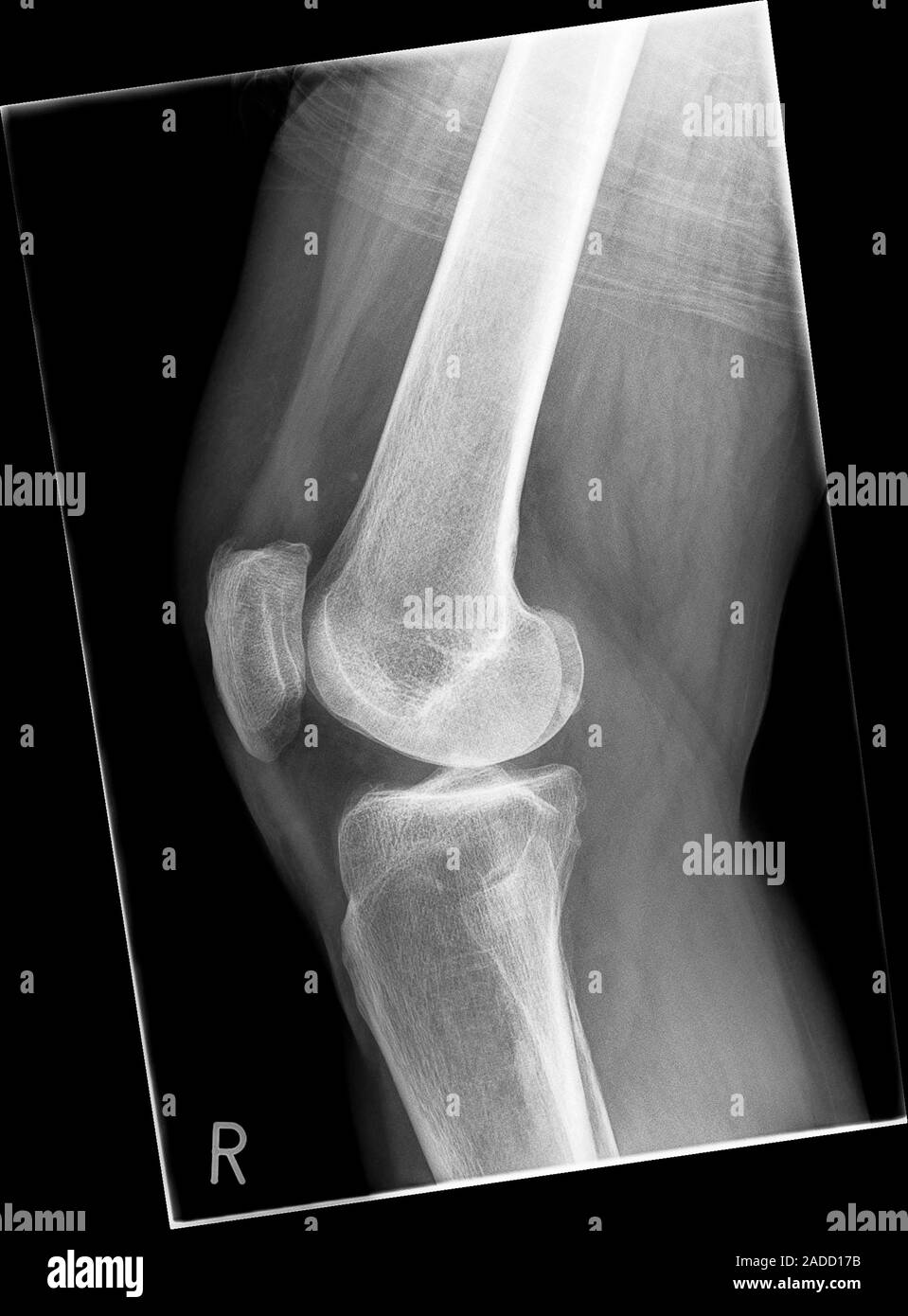 Bipartite patella. X-ray of the knee of a 65-year-old woman with a ...