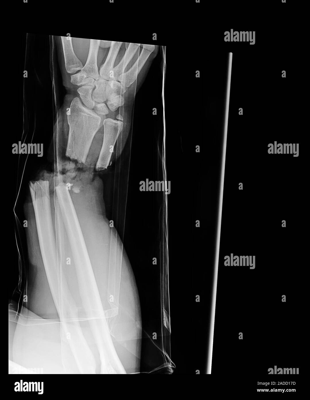 Hand amputation injury, X-ray. Bilateral amputation of this patient's ...