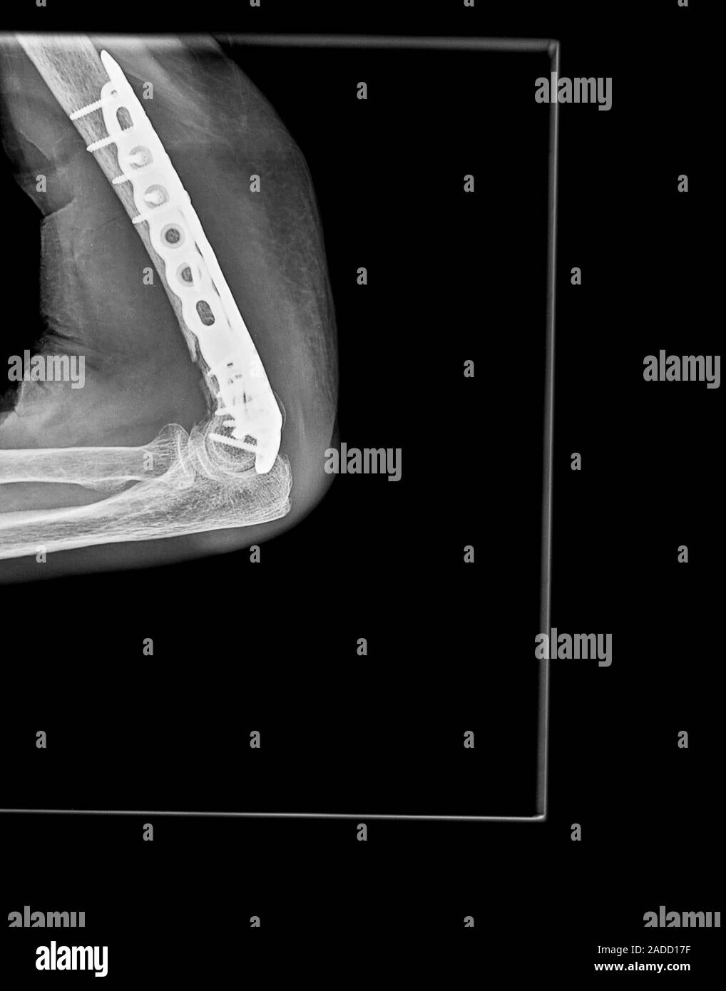 Humerus fracture repair, post-operative X-ray. The patient tripped and ...