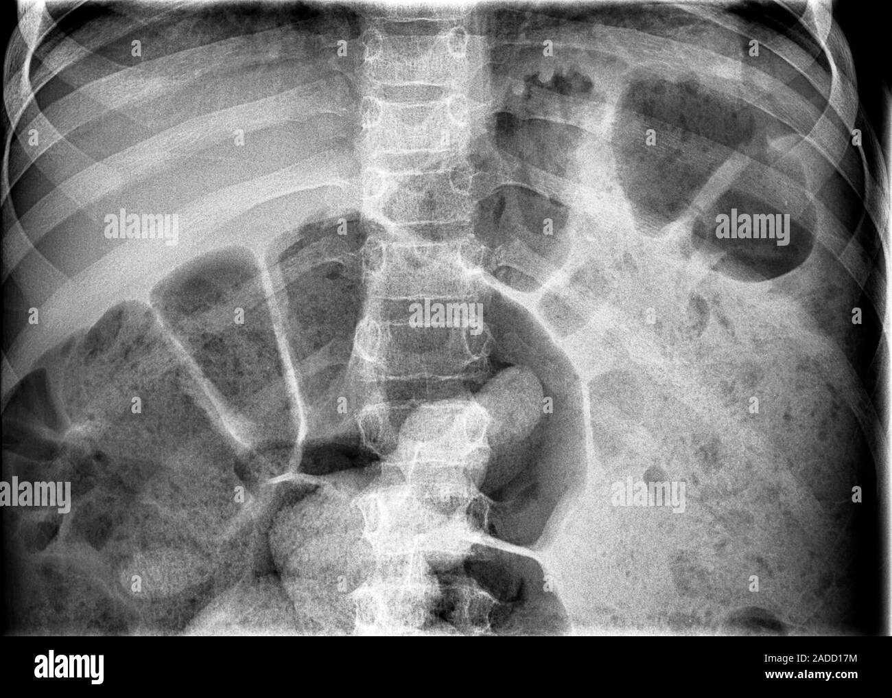 Bowel obstruction, X-ray. The image shows dilatation of the large bowel ...
