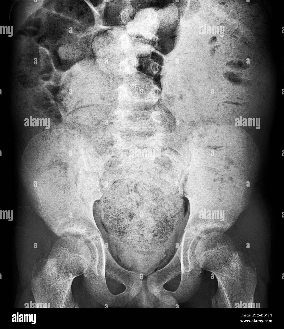Bowel obstruction, X-ray. The image shows dilatation of the large bowel ...