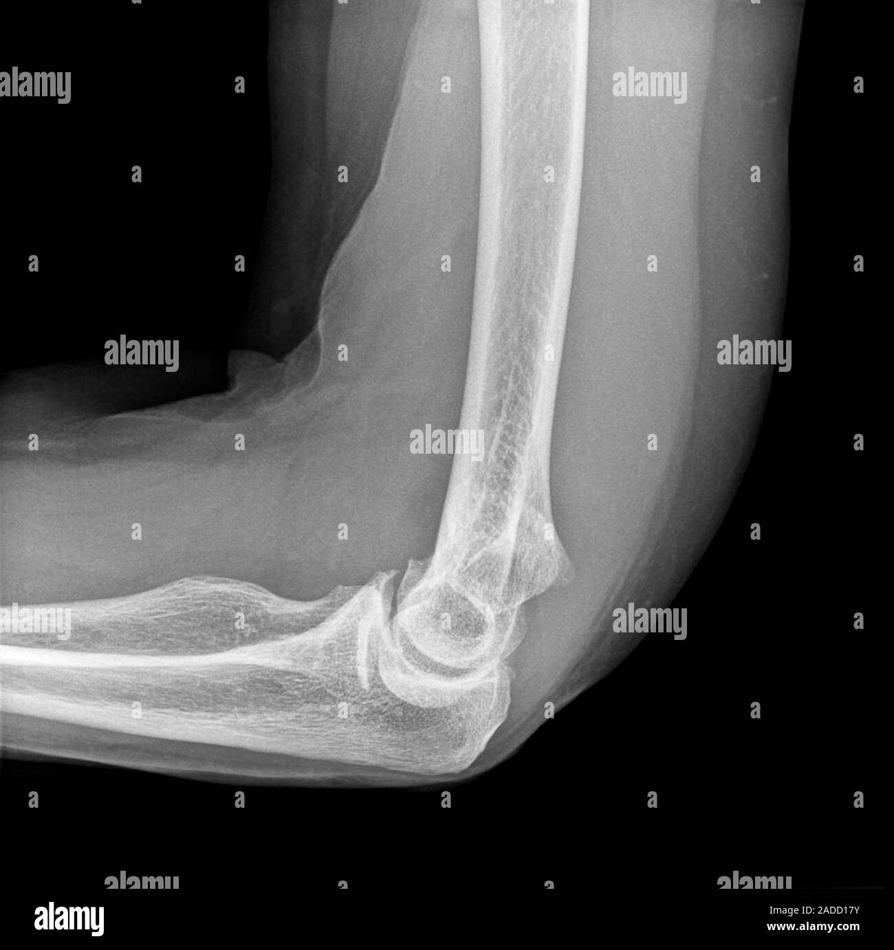 Elbow Fracture X Ray Of The Elbow Of A 75 Year Old Woman With An Elbow Effusion Fluid On The