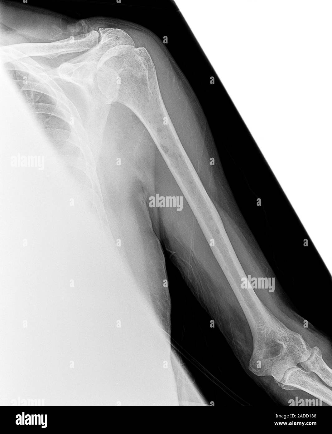 Myeloma bone scan, X-ray. Multiple myeloma is a cancer of plasma white ...