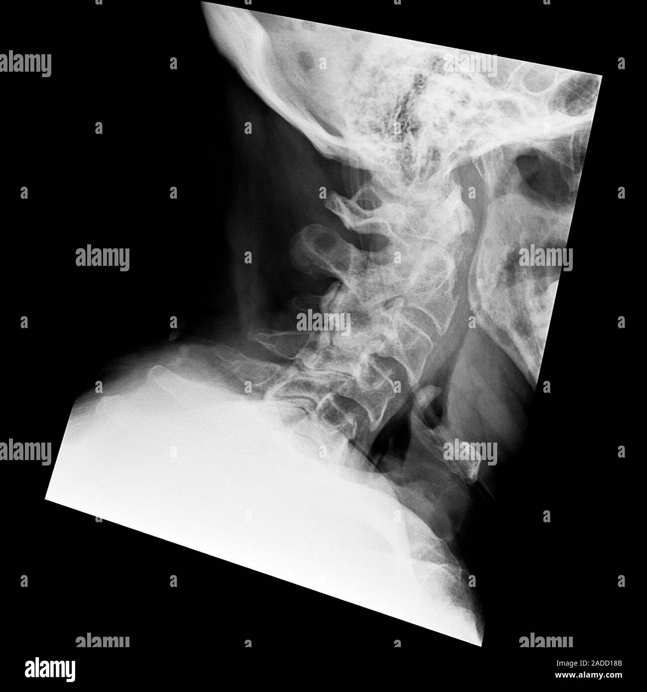 Myeloma bone scan, X-ray. Multiple myeloma is a cancer of plasma white ...