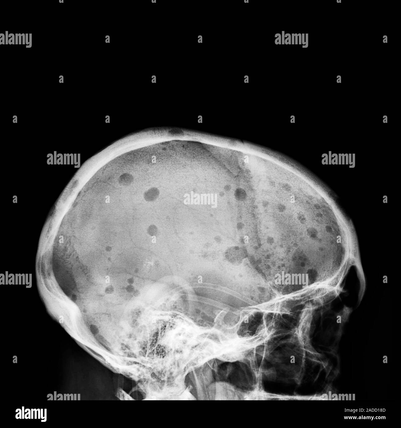 Myeloma bone scan, X-ray. Multiple myeloma is a cancer of plasma white ...