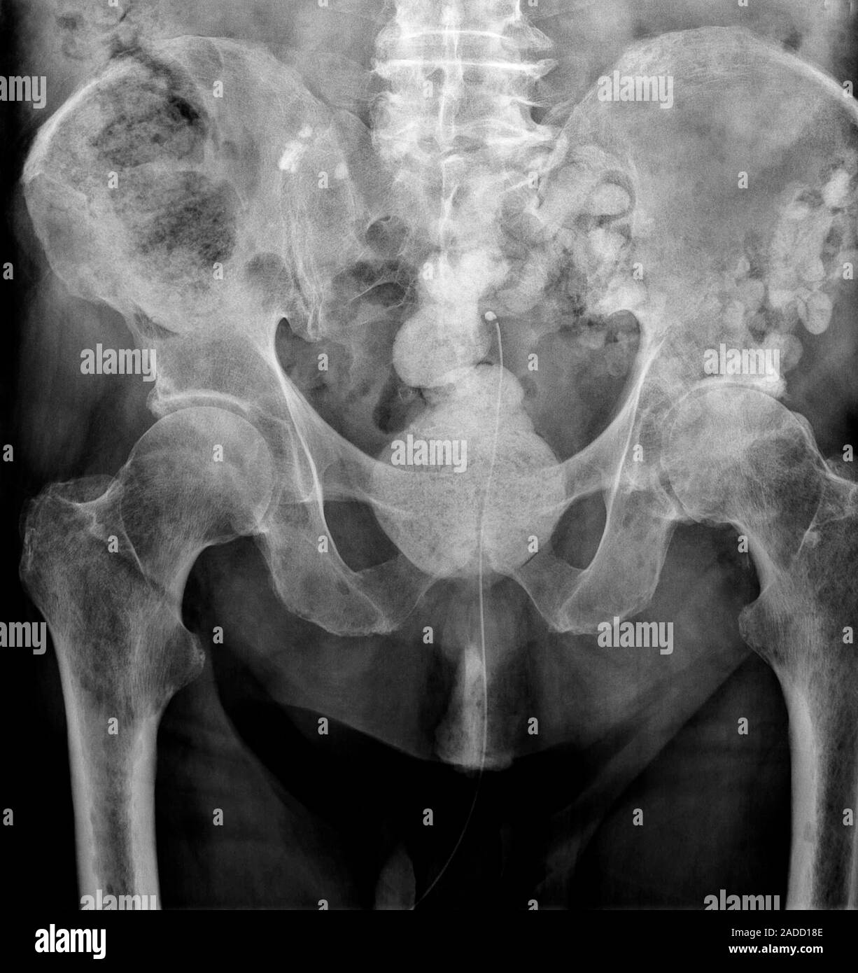 Myeloma bone scan, X-ray. Multiple myeloma is a cancer of plasma white ...