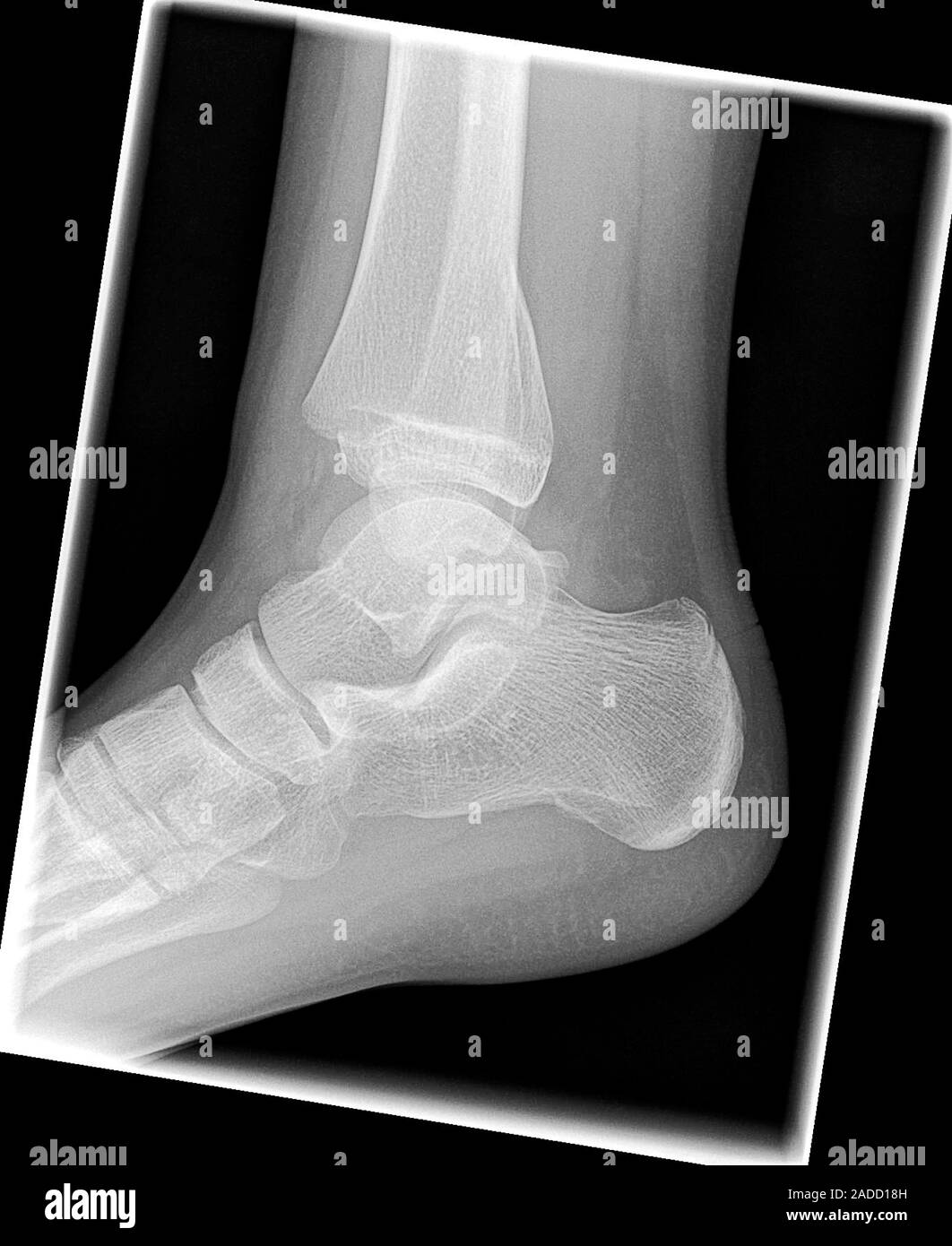 Salter Harris ankle fracture. X-ray of the bones of the ankle of a 14 ...